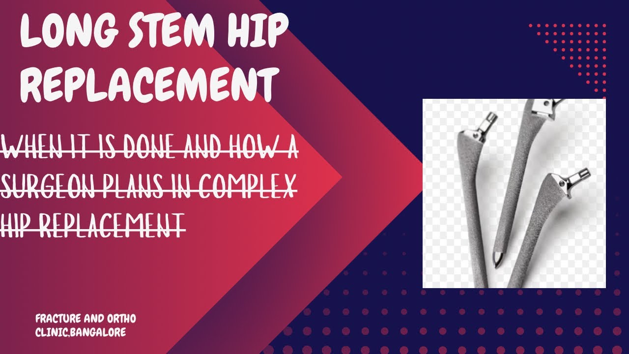 Long stem Hip Replacement - Planning of complex situation with femur ...