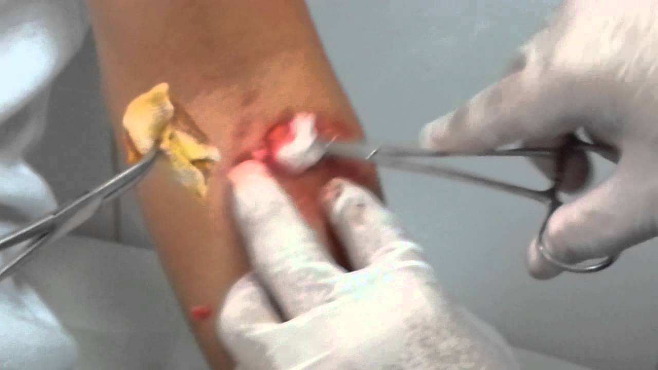 Cyst removal from forearm and one stitch - YouTube