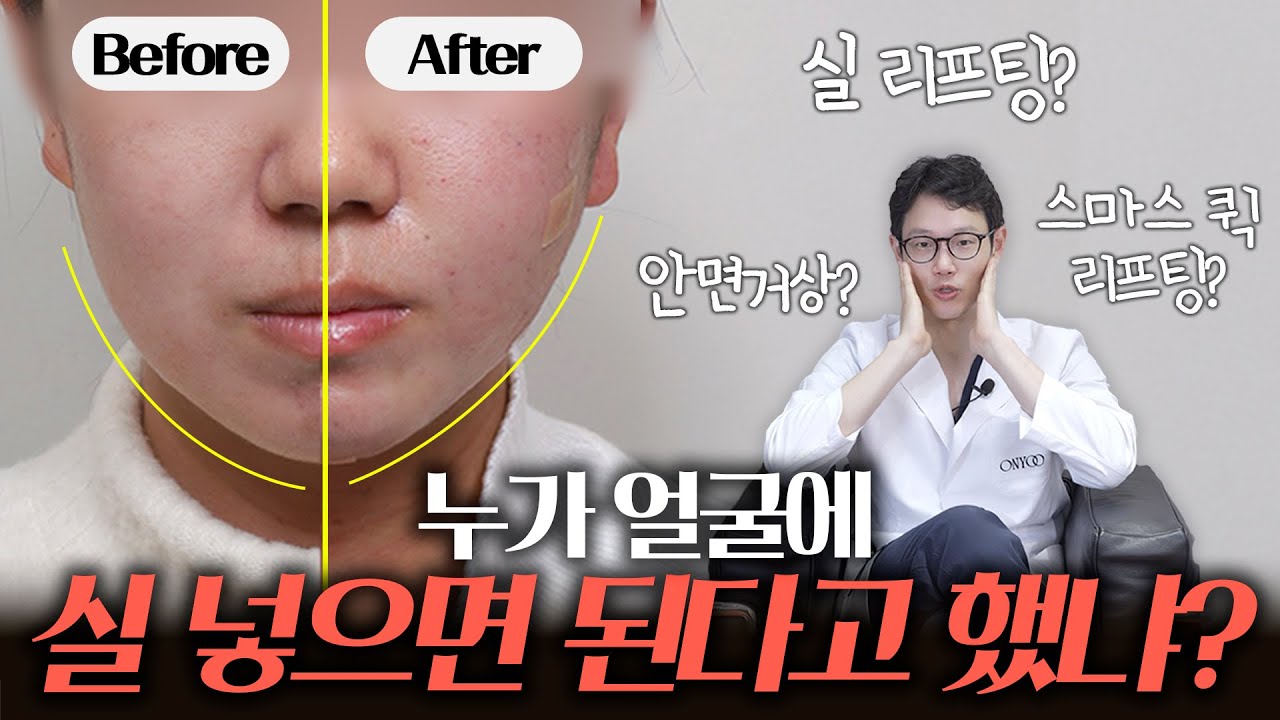 리프팅 너무 종류가 많은데 저는 뭘 해야 하나요┃리프팅 효과 추천 유형 수술 방법 다운타임 유지기간 실리프팅