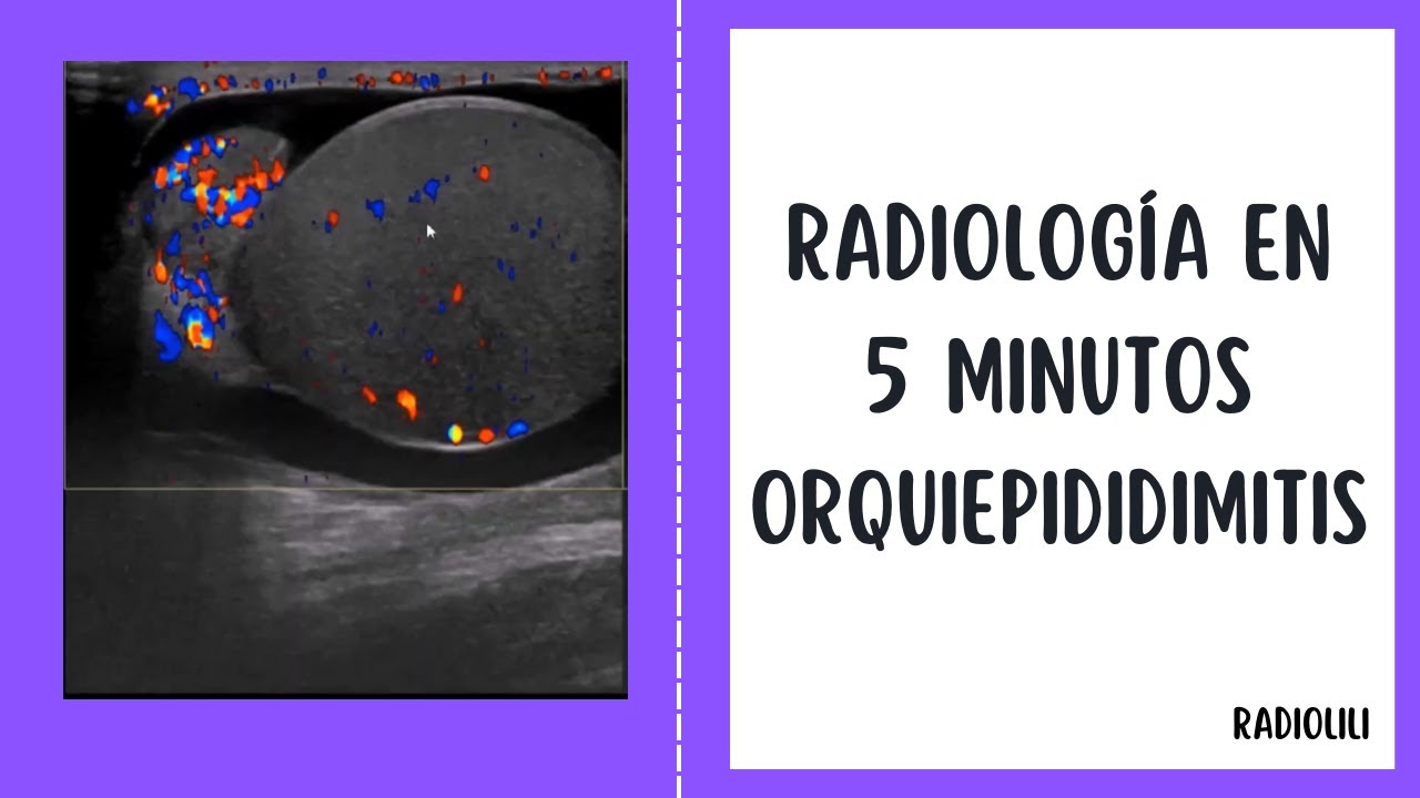 Radiología en 5 minutos: Orquiepididimitis. - YouTube