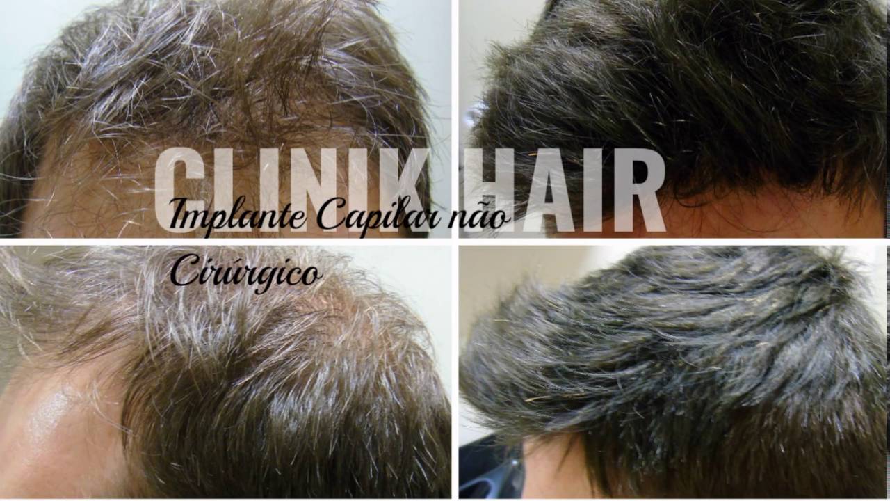 Prótese Capilar Clink Hair Itajaí-SC - YouTube