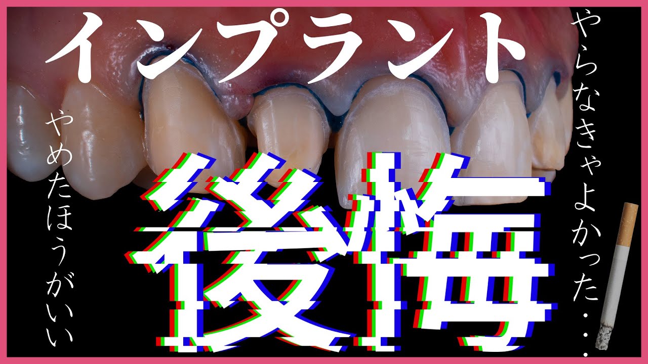 【インプラント】やめたほうがいい。やらなきゃよかったと後悔しないための歯医者の見解をお話します。 Youtube