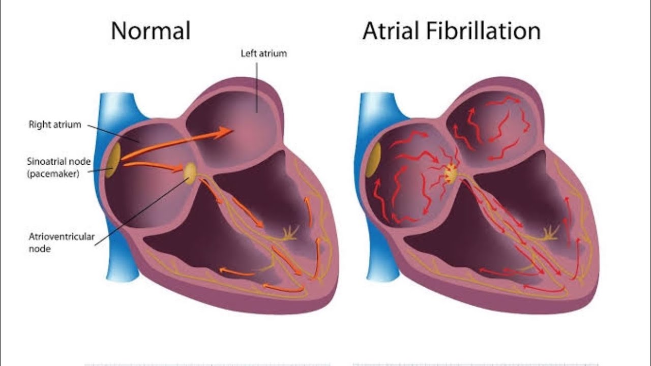 Atrial Fibrillation Mnemonic - YouTube