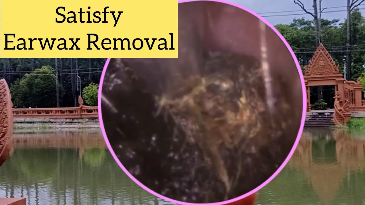 Satisfying Ear Wax Removal Compilation - YouTube