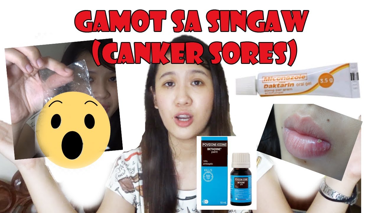 5 pesos remedy sa SINGAW (Canker Sores) | Micha C. - YouTube