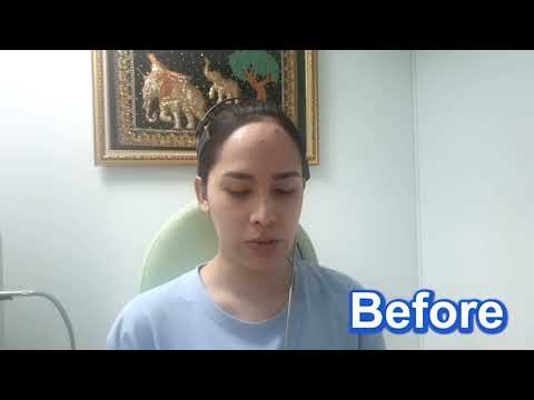MTF VOICE CHANGE SURGERY afetr 2 months by Dr.ORNOUMA ENT - YouTube