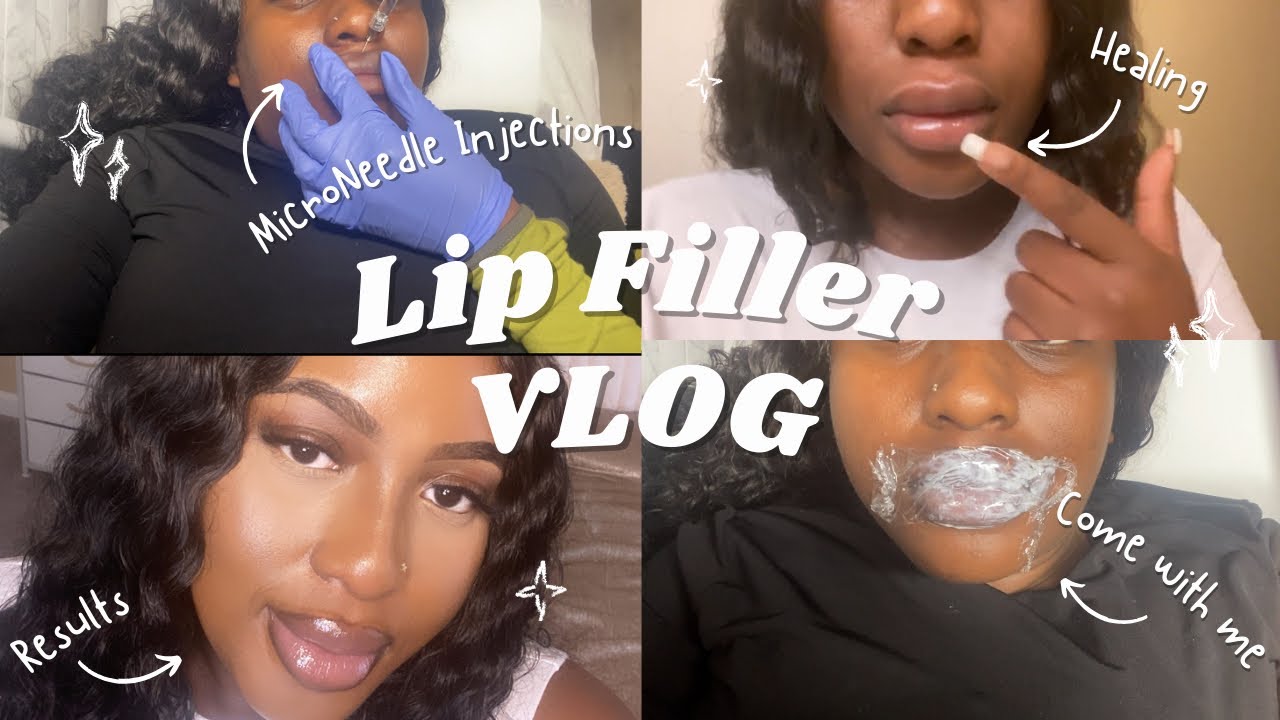LIP FILLER VLOG: Come with me to my appointment| Needle-less vs Needle ...