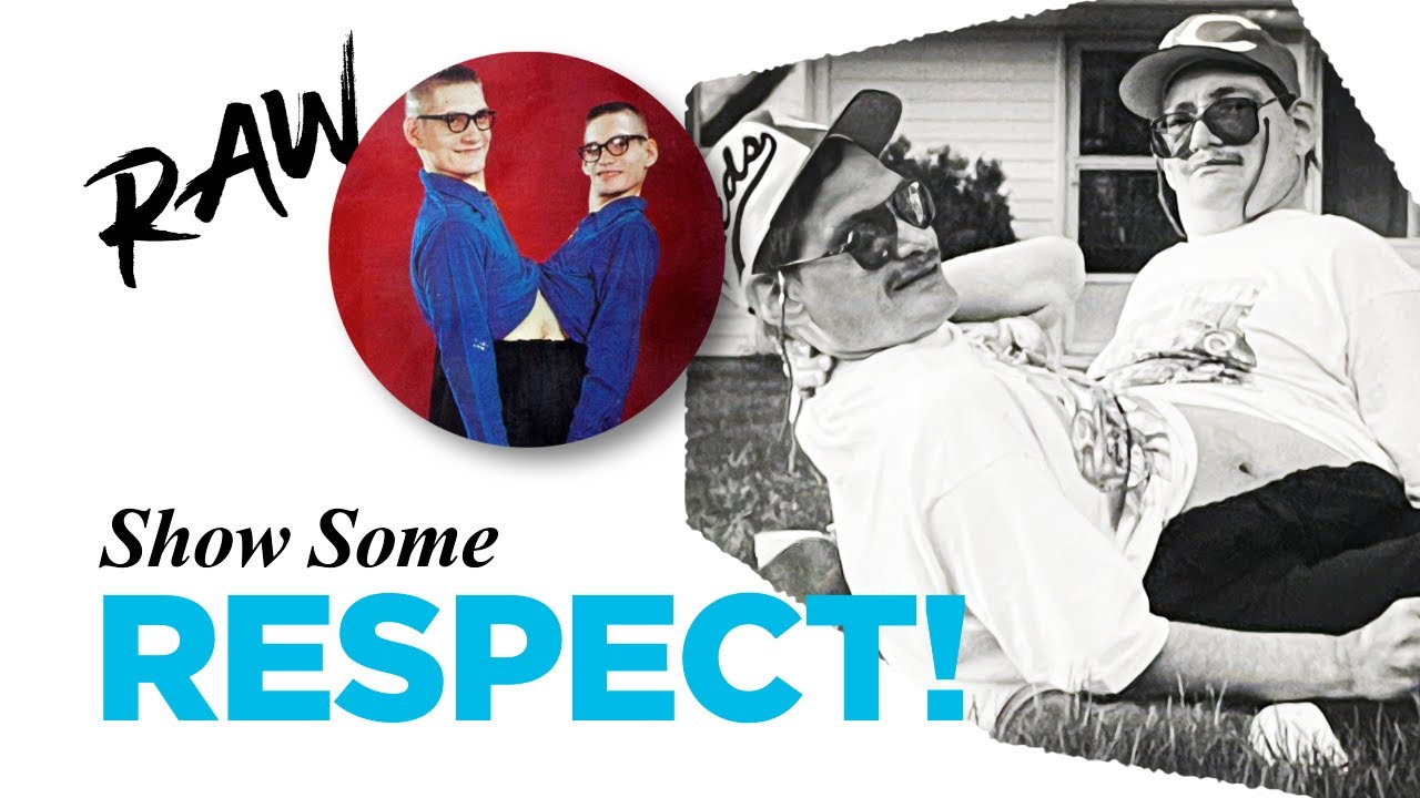 Amazing Life as Conjoined Twins: Ronnie and Donnie Galyon Speak Out ...