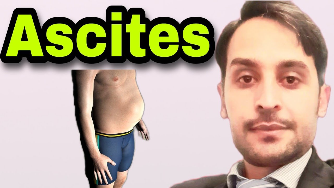 Ascites | Causes | Symptoms | Diagnosis | Treatment - YouTube