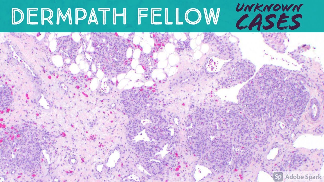 Dermpath Fellow Slide Session: Kaposiform hemangioendothelioma ...