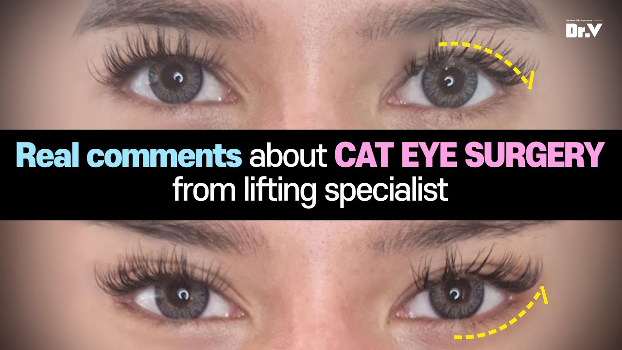 Facelift FAQ) Is there a reason why VLIF doesn't do an eye lift? - YouTube