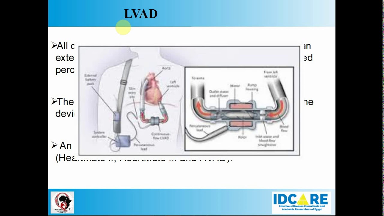 LVAD Infections - YouTube