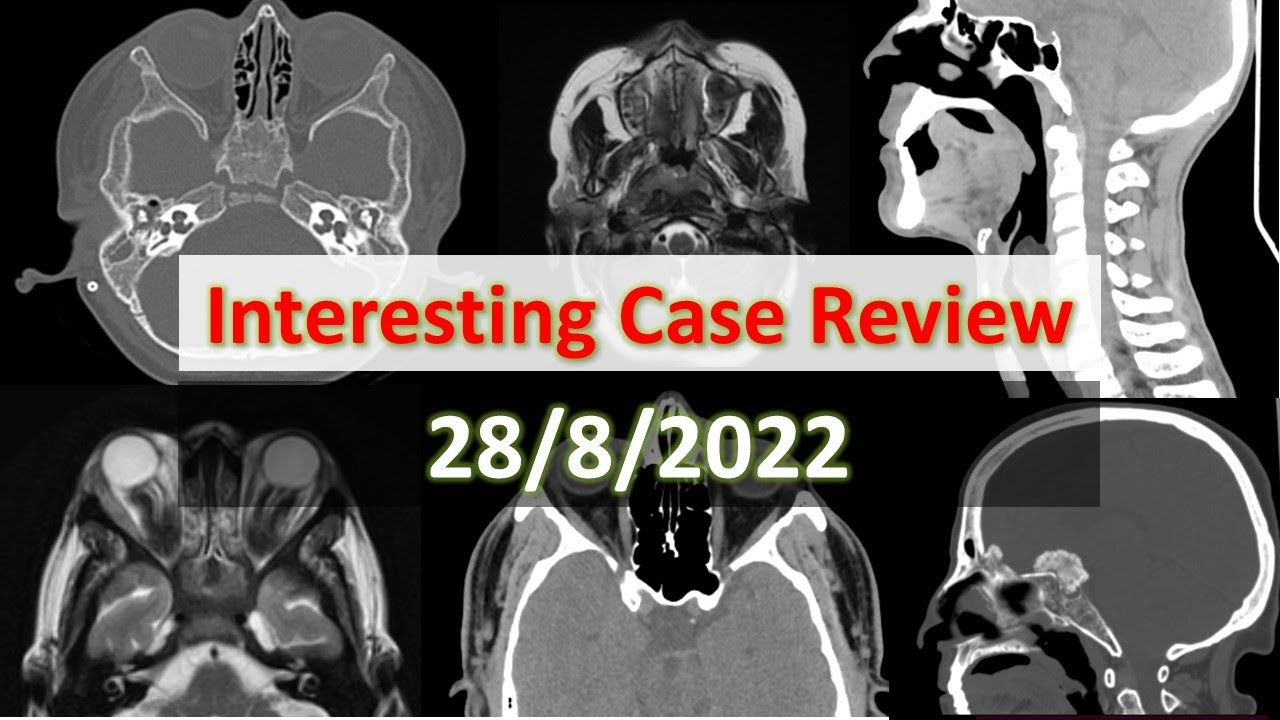 Interesting Cases Review 28/8/2022 - YouTube