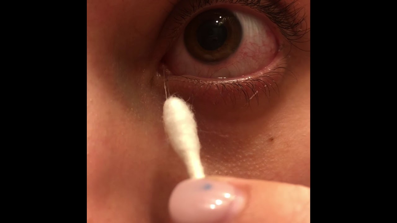 Fishing For Eye Mucus Mucus Fishing Syndrome YouTube