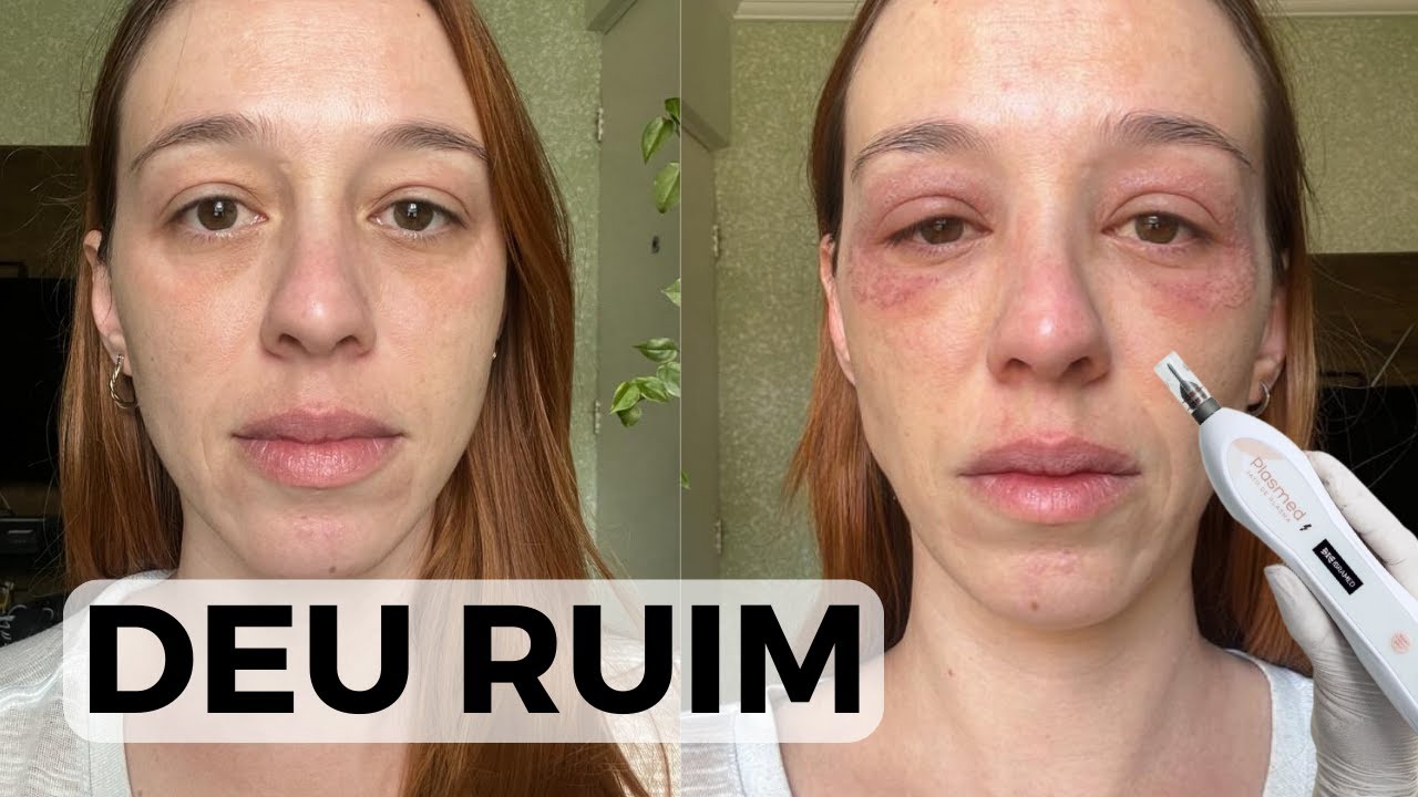 JATO DE PLASMA: Fiz esse procedimento e vim mostrar tudo pra vocês com ...