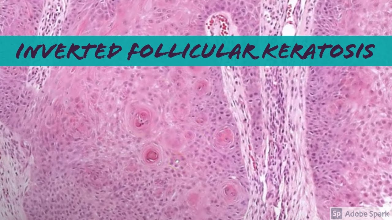 Inverted Follicular Keratosis (IFK): 5-Minute Pathology Pearls - YouTube