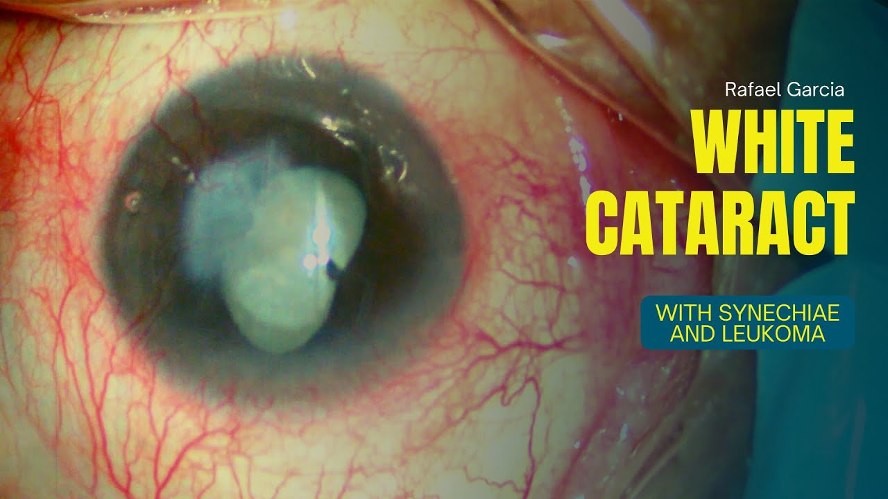 Corneal Leukoma + White Cataract + Posterior Synechiae (Oft-Review Film ...
