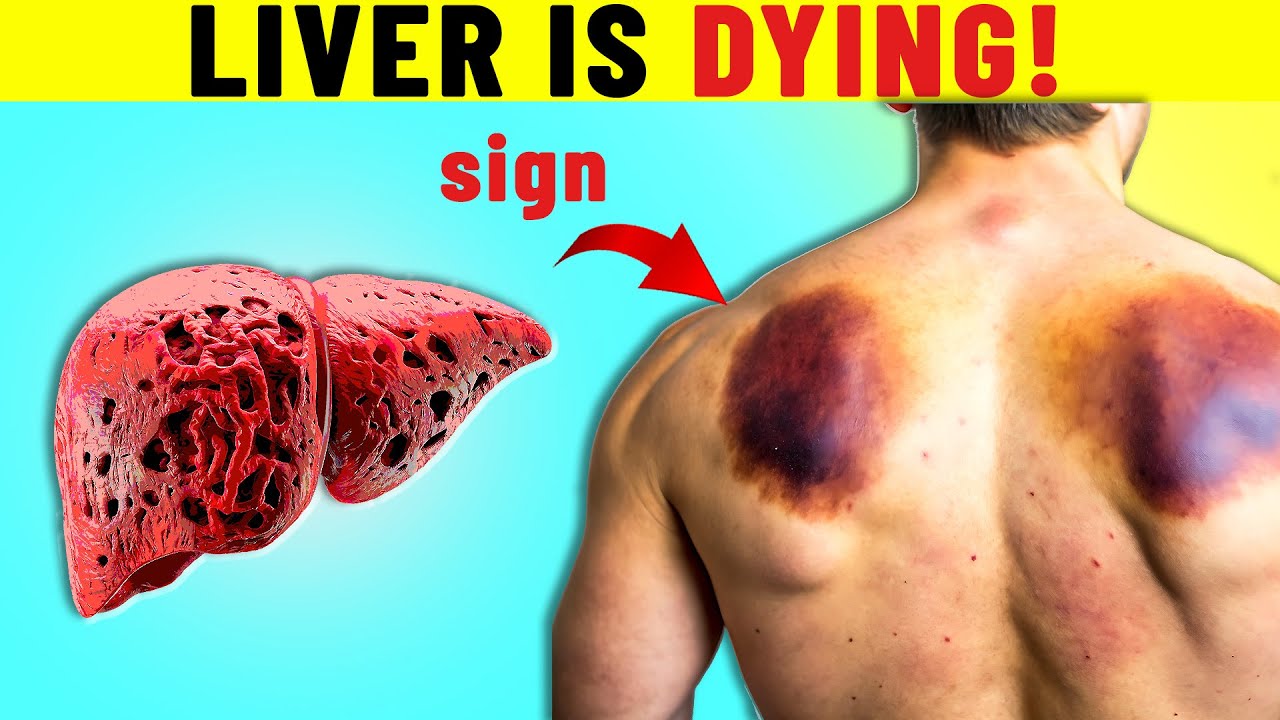 10 Shocking Signs Your Liver is Crying for Help! - YouTube