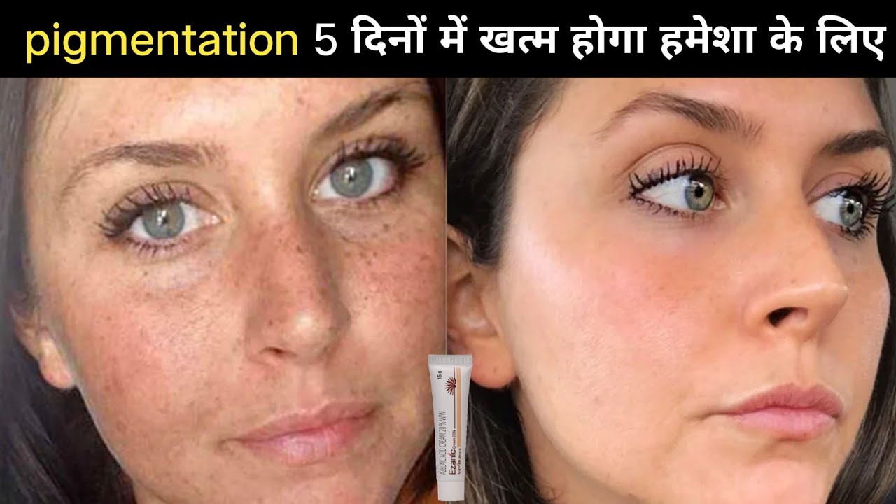 Azalaic Acid Cream Benefits & Side Effects, Skin Lightening Cream ...