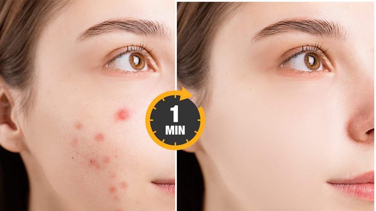 How To Remove Pimples Adobe Photoshop | Remove Pimple Marks From Face ...