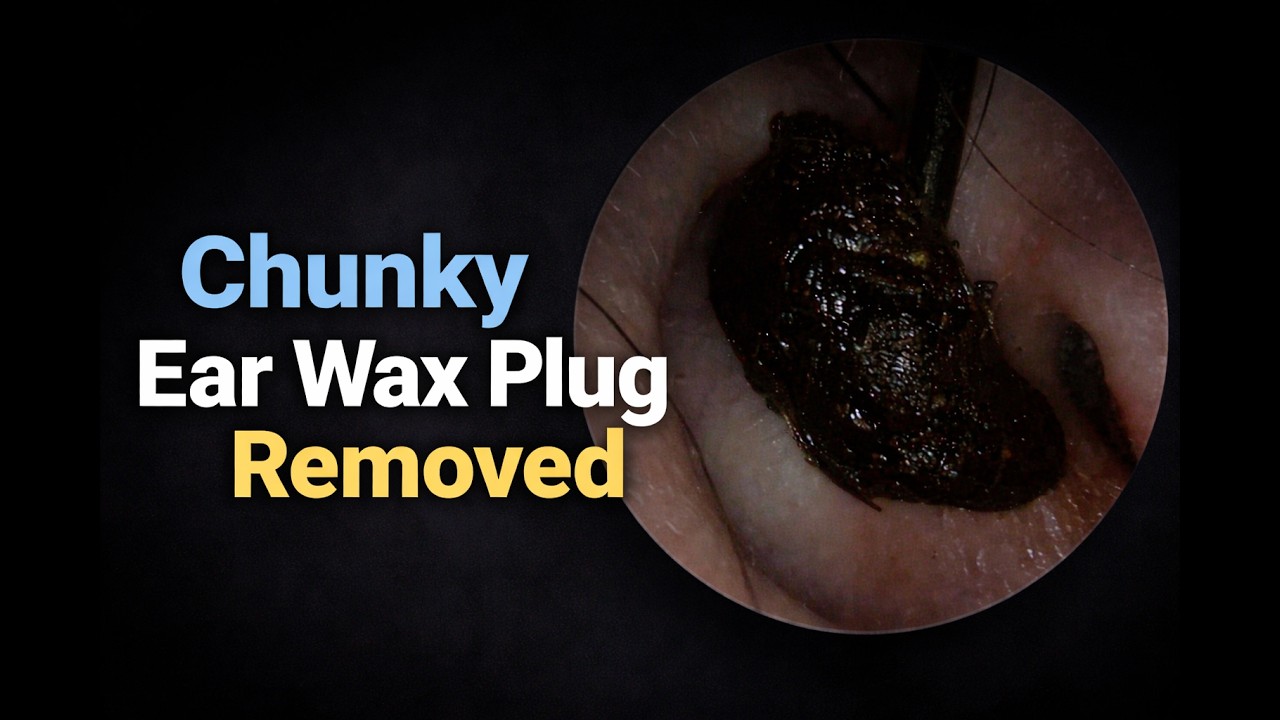 Two Chunky Ear Wax Plugs in Narrow Canals – Careful Manual Removal ...