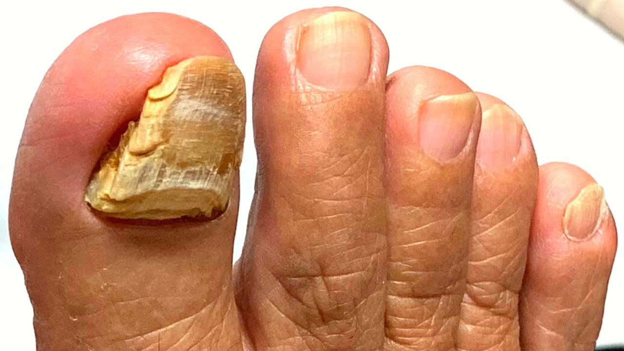 Too Sensitive To Cut?! SUPER THICK Layered Nail Cutting! - YouTube