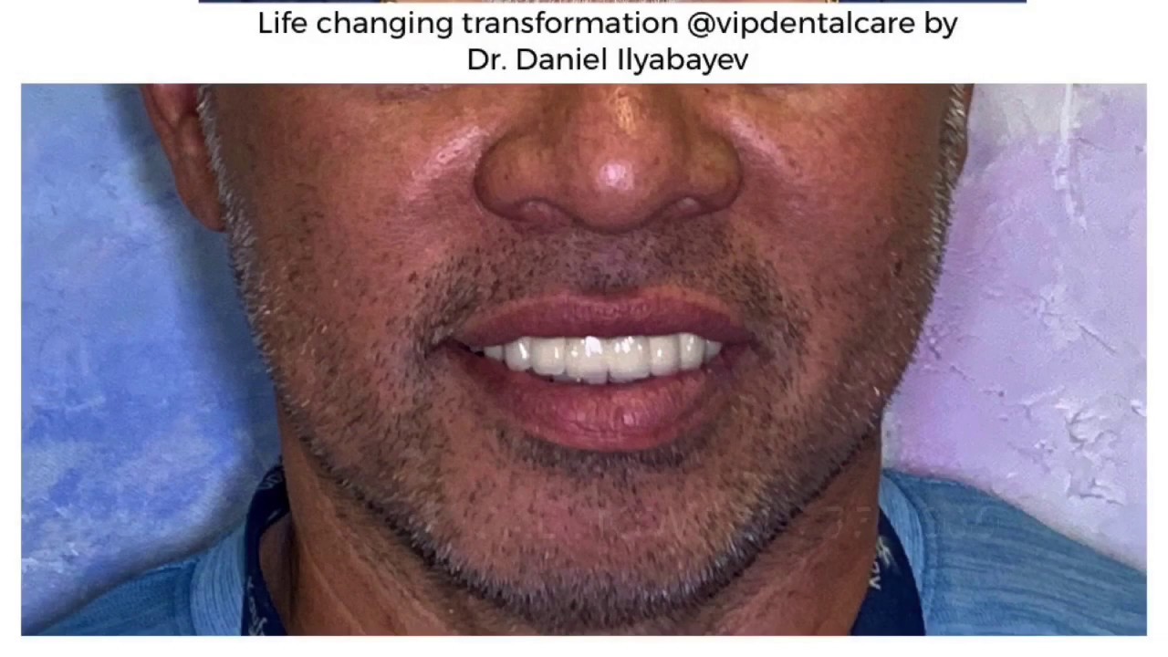 Smile Makeover at VIP Dental Care in Forest Hills, Queens - YouTube
