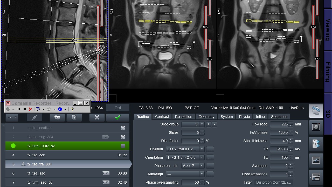 MRI planning L-spine - YouTube
