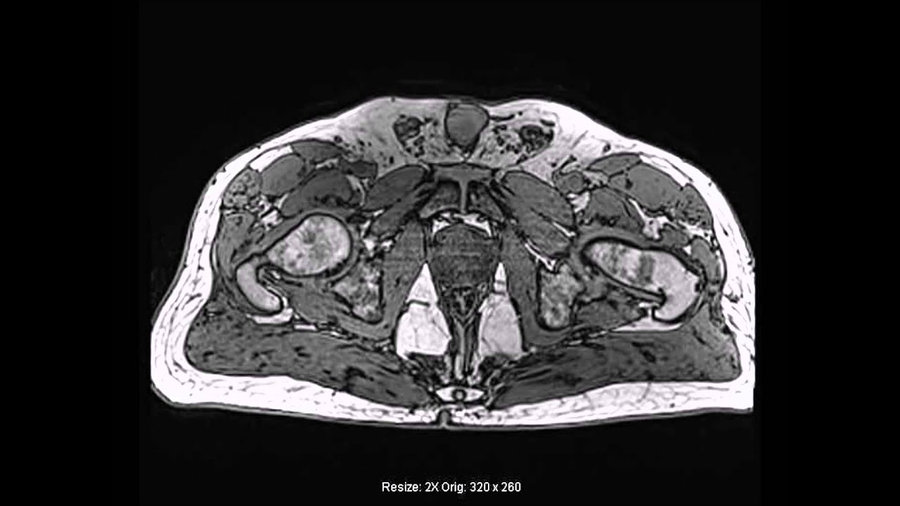 Pelvis MR - YouTube