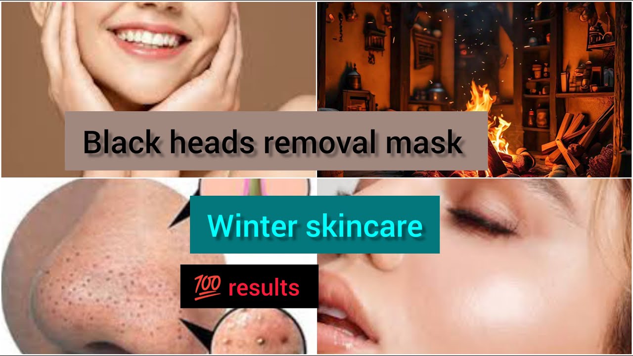BLACKHEADS REMOVAL MASK for Acne-Prone skin| Winter skincare routine ...