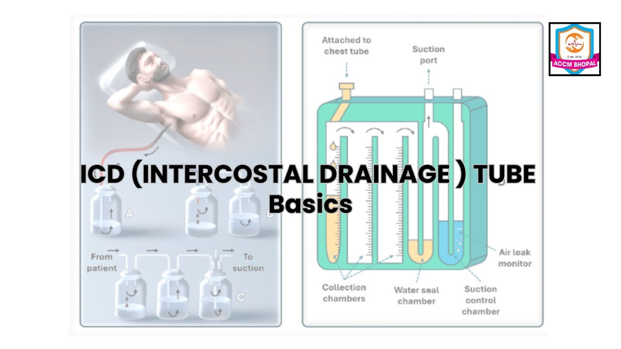 Intercostal Drainage Tube Basics - YouTube
