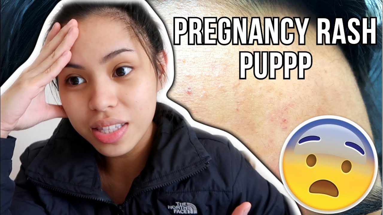 VLOG: PUPPP Rash Outbreak! 😱with PHOTOS - YouTube