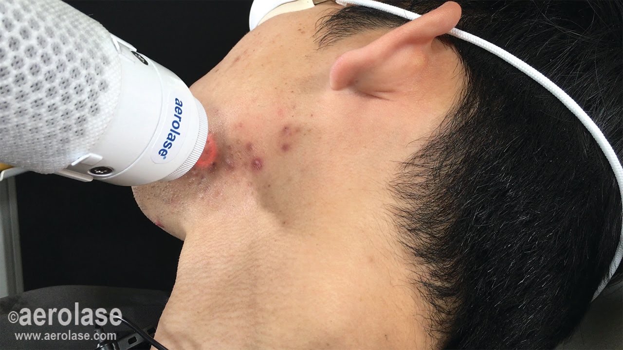 Testimonial & Demo | NeoClear Acne Treatment on Asian Skin - YouTube
