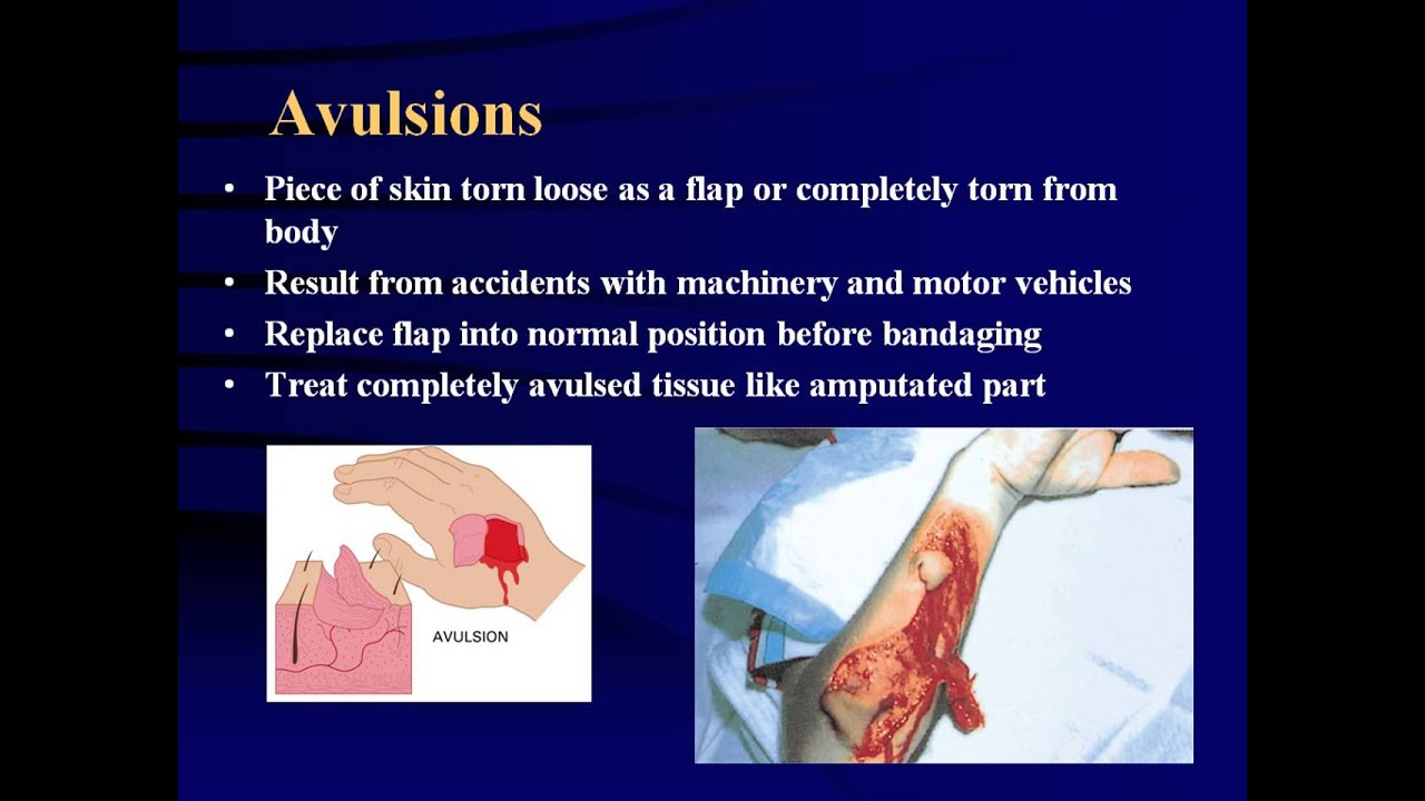 EMT-SOFT TISSUE INJURIES 2.20.12 - YouTube