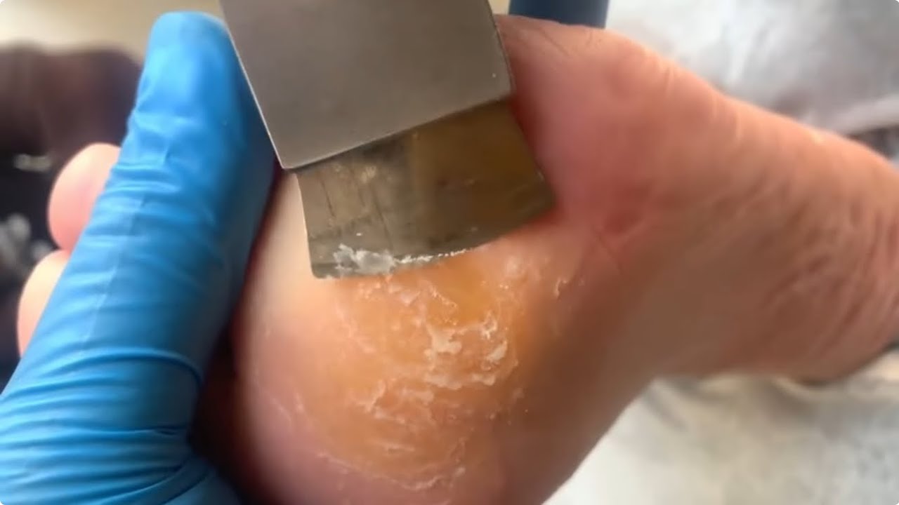Why Foot Calluses Keep Coming Back (And How to Prevent Them) - YouTube