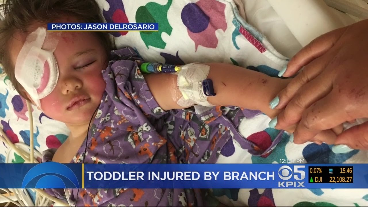 Toddler Recovering With Fractured Skull After Massive Tree Branch Fall ...