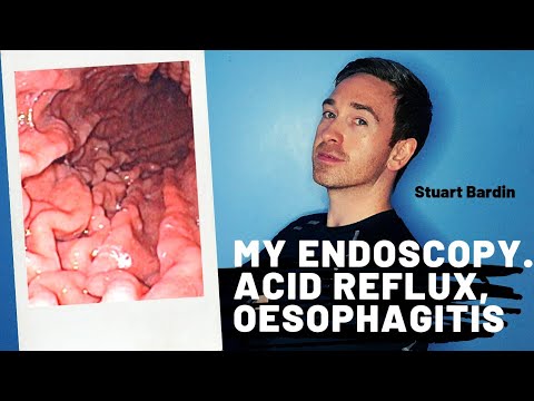 My Endoscopy Procedure And Findings. Acid Reflux, Oesophagitis, Silent ...