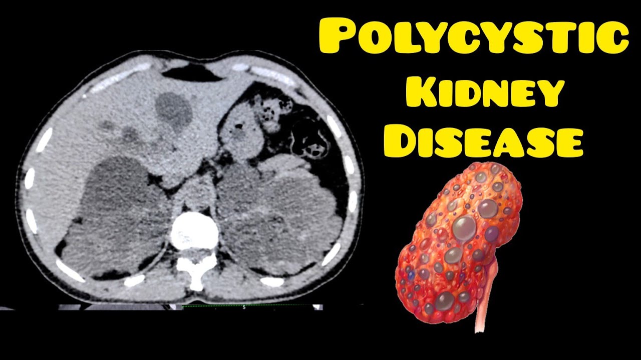 Polycystic kidney liver disease | CT Scan | Radiology | - YouTube
