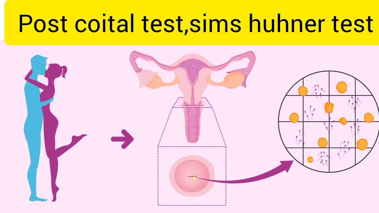 Post Coital Test Sims Test huhner Test sims Huhner Test PCT Test post-coital-test-sims-test-huhner-test-sims-huhner-test-pct-test