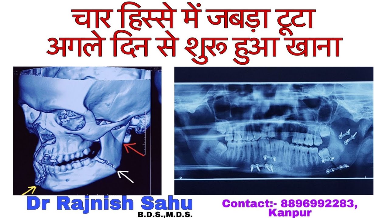 Multiple Fractures of Jaw || No Dental Wiring || Mandible # - YouTube