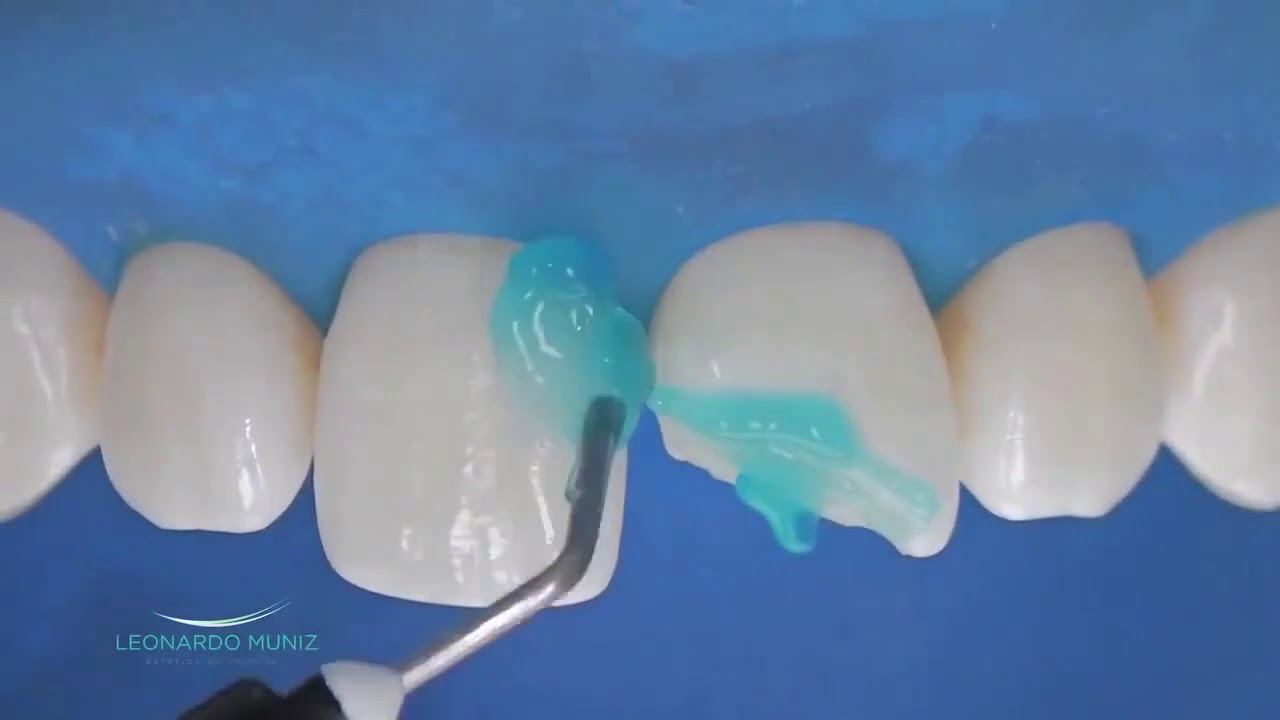 Anterior teeth restoration class IV - YouTube
