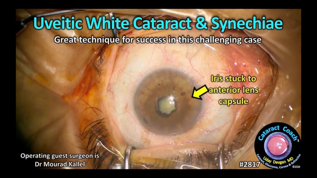 CataractCoach™ 2817: uveitic white cataract with synechiae, small pupil ...