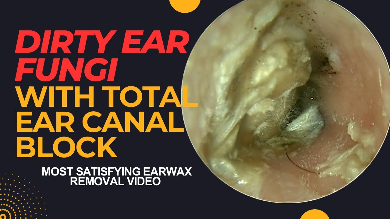 DIRTY Ear Fungi With TOTAL Ear Canal Block - YouTube