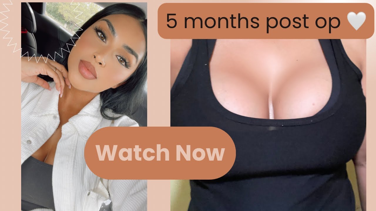 5 MONTH BREAST AUGMENTATION POST OP UPDATE answering Your Questions 5-month-breast-augmentation-post-op-update-answering-your-questions