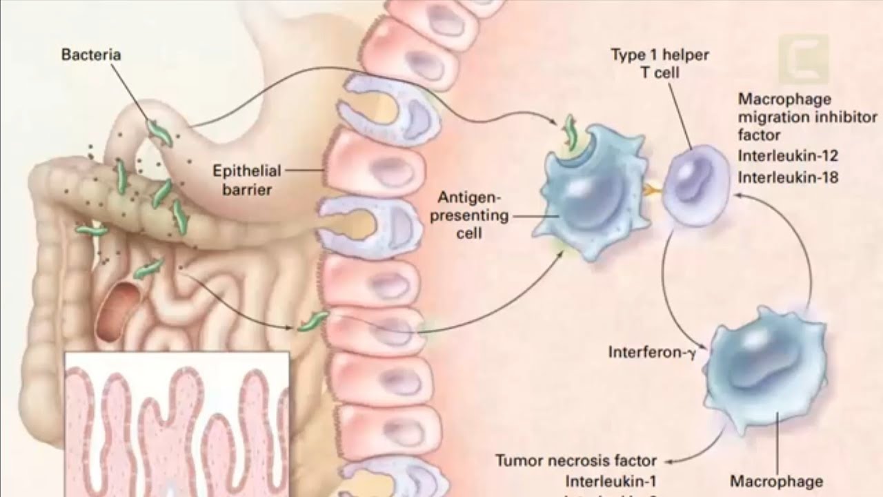 GIT Drugs-lecture-13- Inflammatory bowel disease IBD-Crohn's disease ...