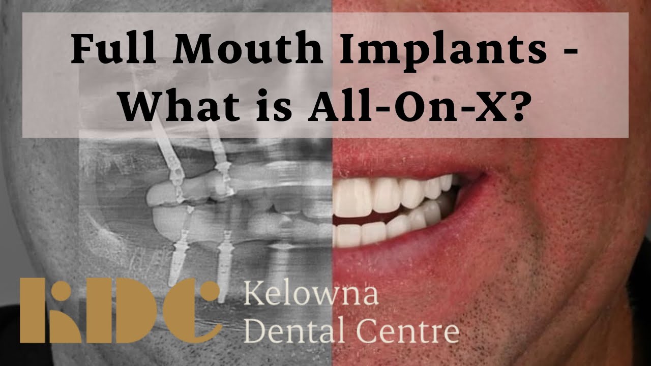 Full Mouth Implants - What is All-On-X? - YouTube