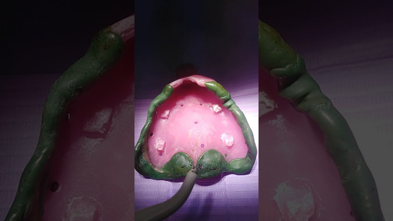 Visit 2: Upper posterior border moulding: features and reasons for the ...