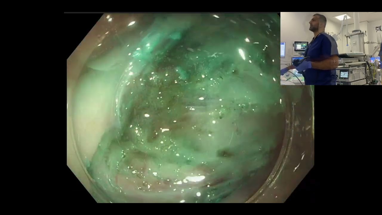 Dr Rehan Haidry carries out a Z-POEM procedure - YouTube