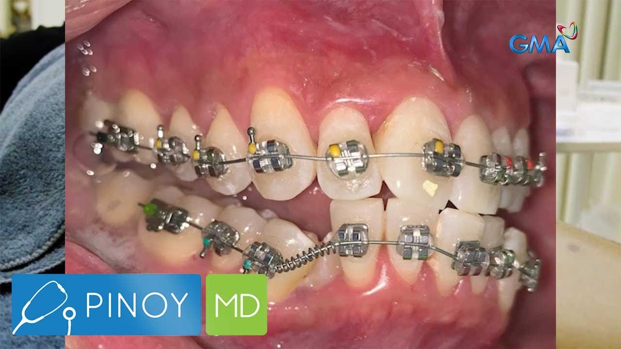 Ngipin na nasira ng DIY braces, maisasalba pa kaya? | Pinoy MD - YouTube