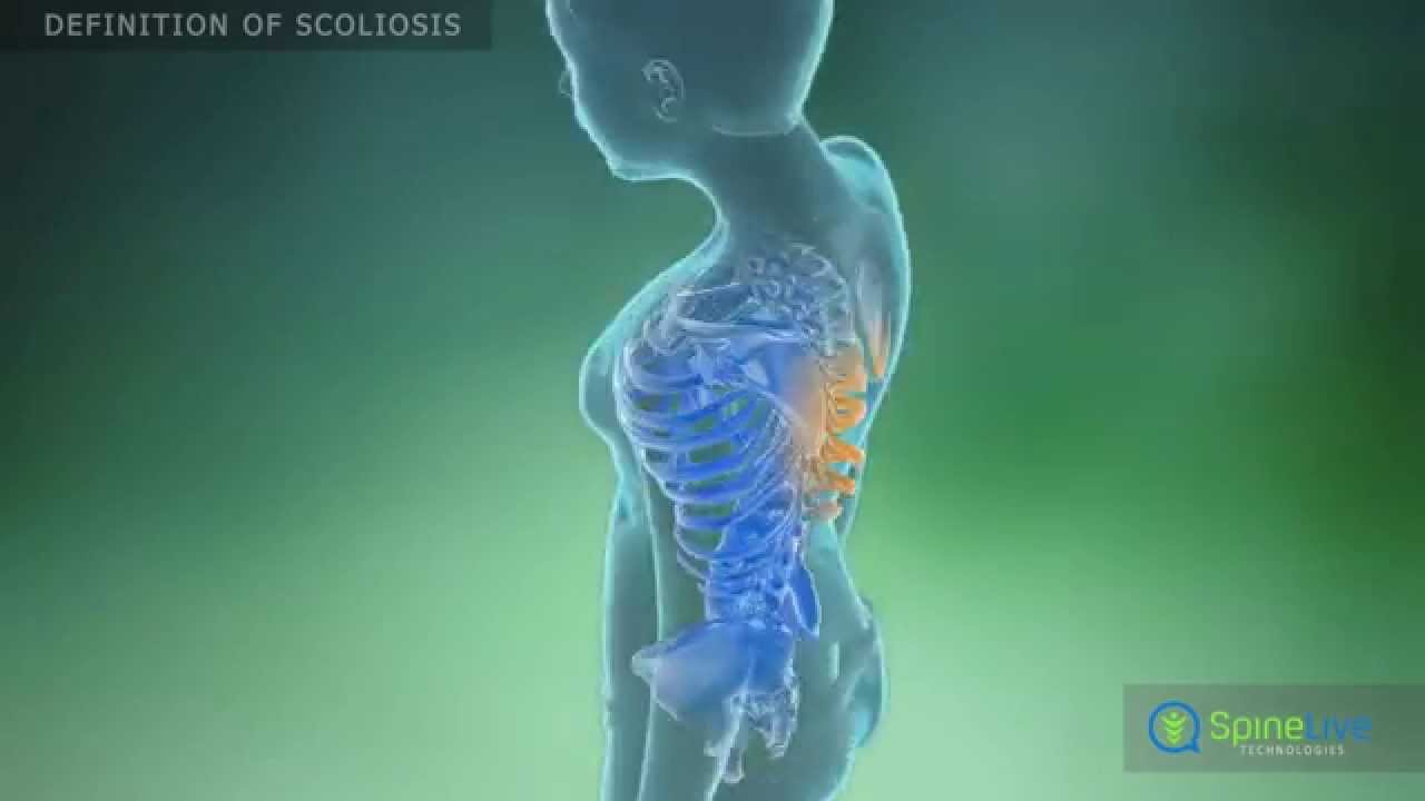 Scoliosis Definition - YouTube